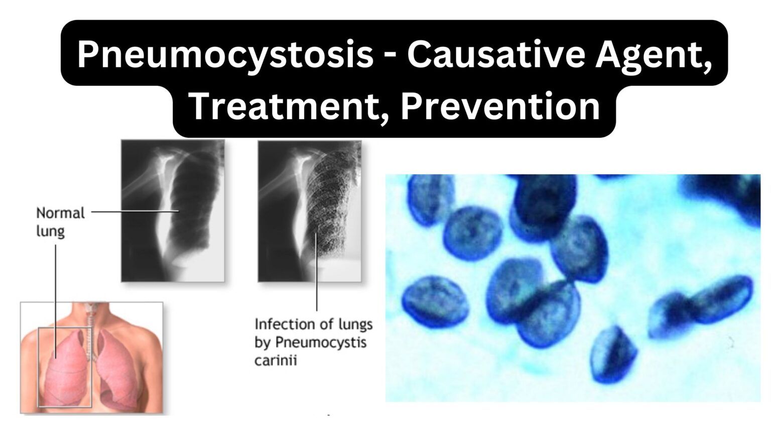 Cryptococcus Neoformans Structure Infection Habitat Biology Notes Online