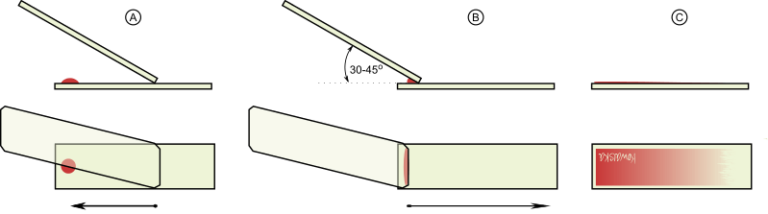 Thick and Thin Blood Smear for Malaria Diagnosis - Biology Notes Online