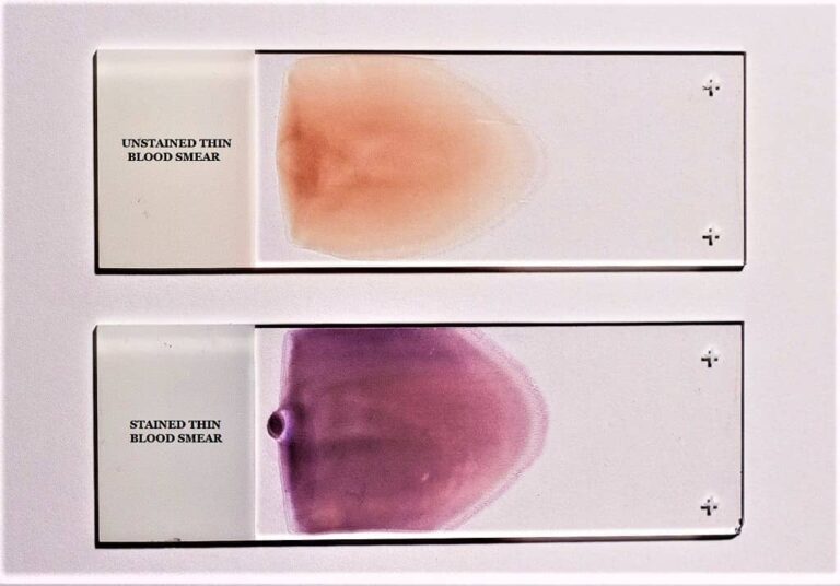 Thick and Thin Blood Smear for Malaria Diagnosis - Biology Notes Online