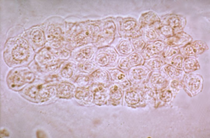 Hyaline Casts in Urine - Types, Morphology, Clinical Significance ...