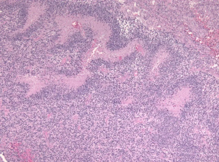 Necrosis - Definition, Types, Mechanism, Causes - Biology Notes Online