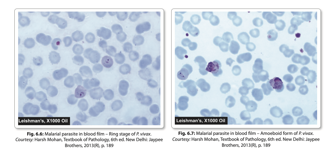 Malaria - Parasite, Life Cycle, Pathogenesis, Diagnosis, Treatment ...